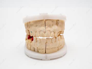 Plaster Model or Cast of Human Teeth. Stock Image - Image of ...