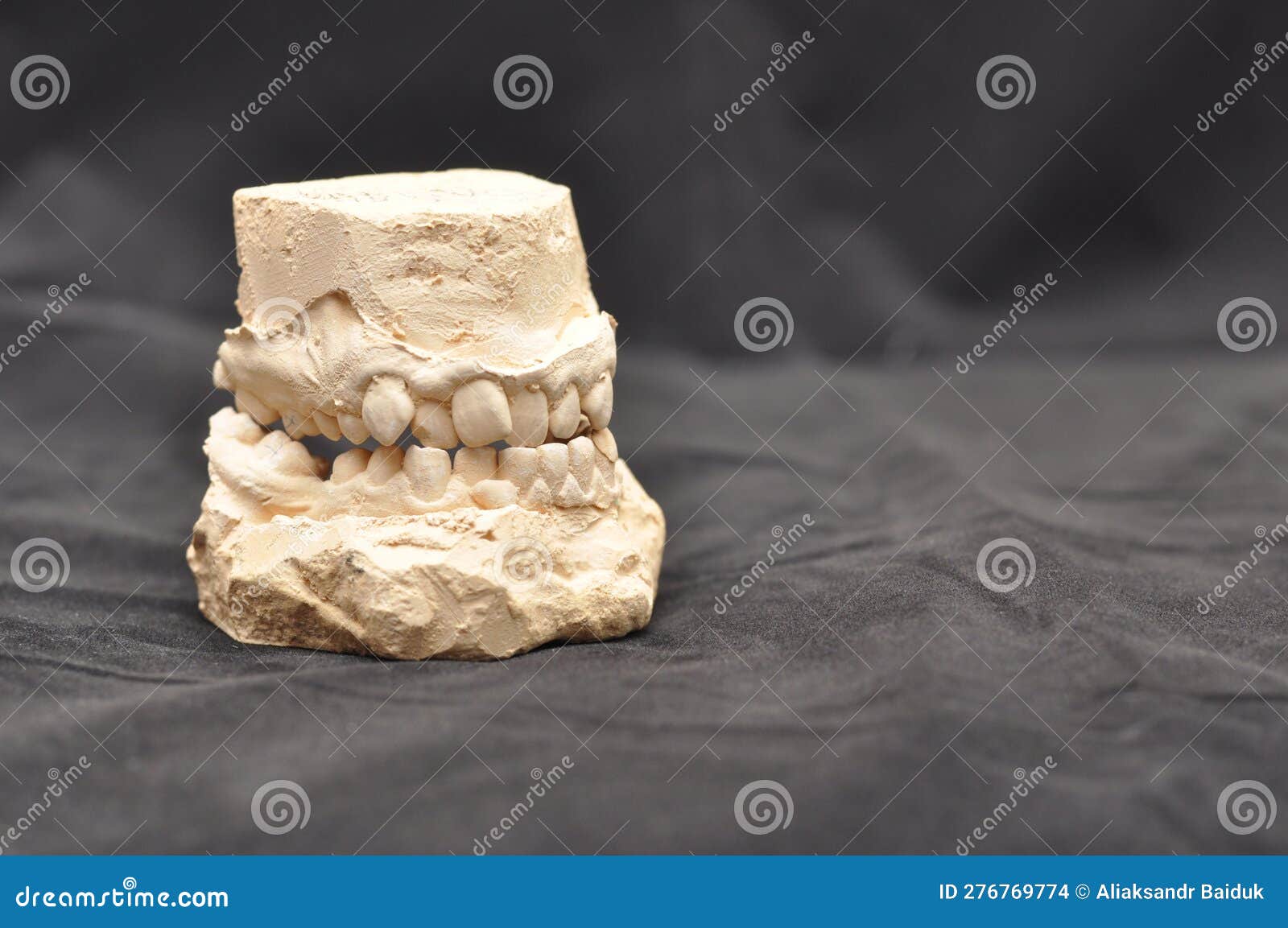 Plaster Model or Cast of Human Teeth. Strongly Crooked Teeth Stock ...