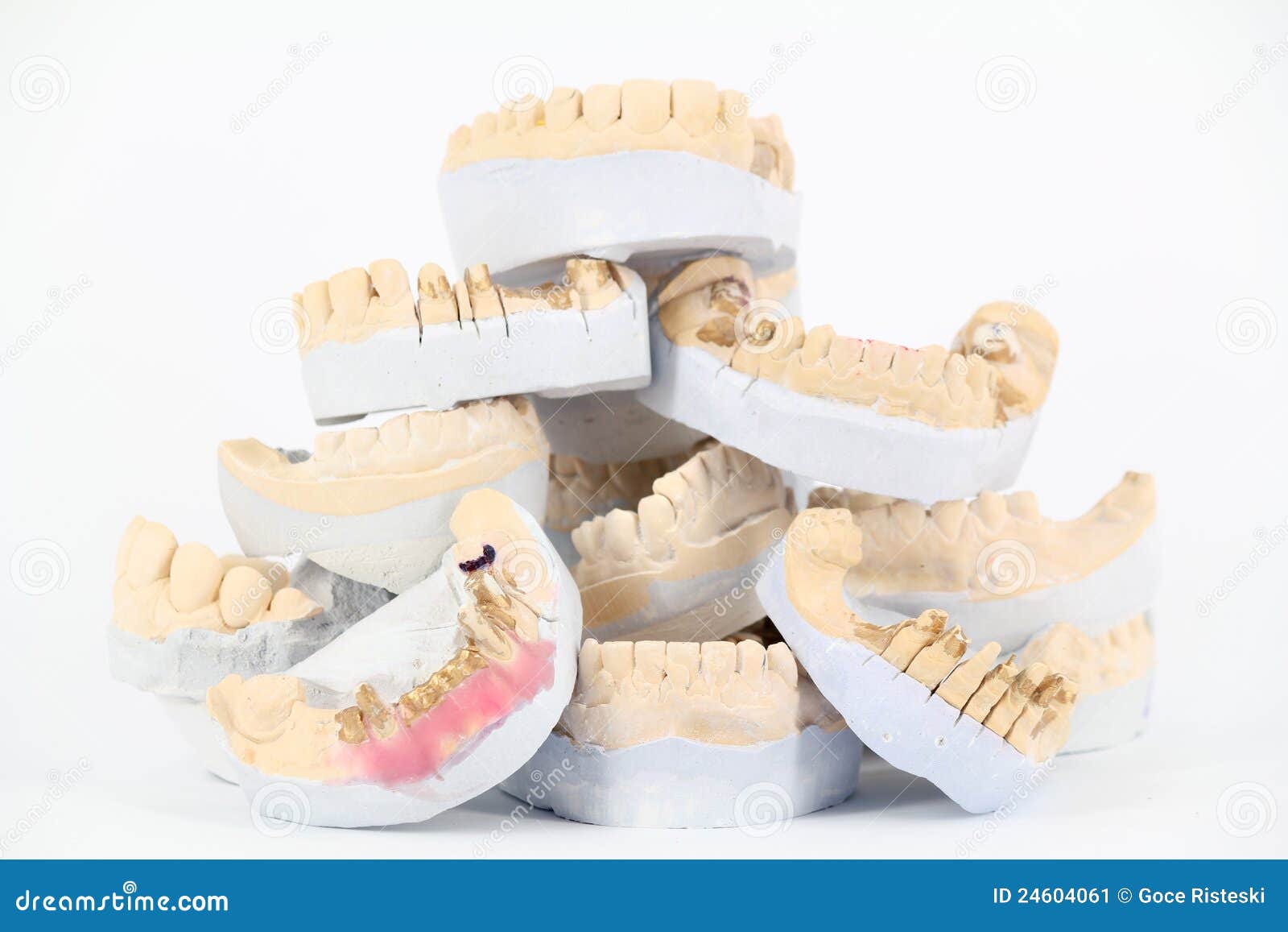 Plaster Model Before And After A Brace Stock Image | CartoonDealer.com ...