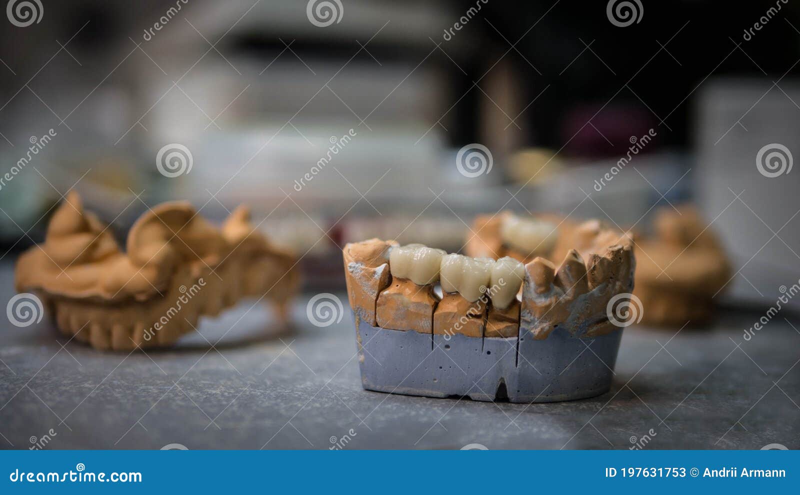 Plaster Model of Teeth on a Work Table,a Dental Technician Makes a ...