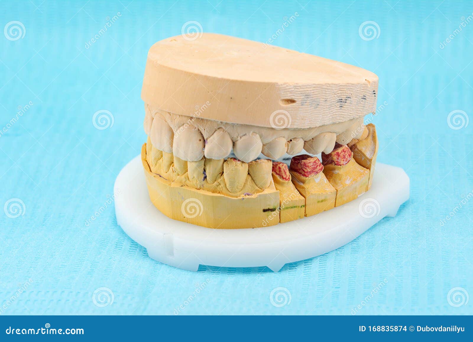 Dental Lab Plaster Technician at Lawrence Melson blog
