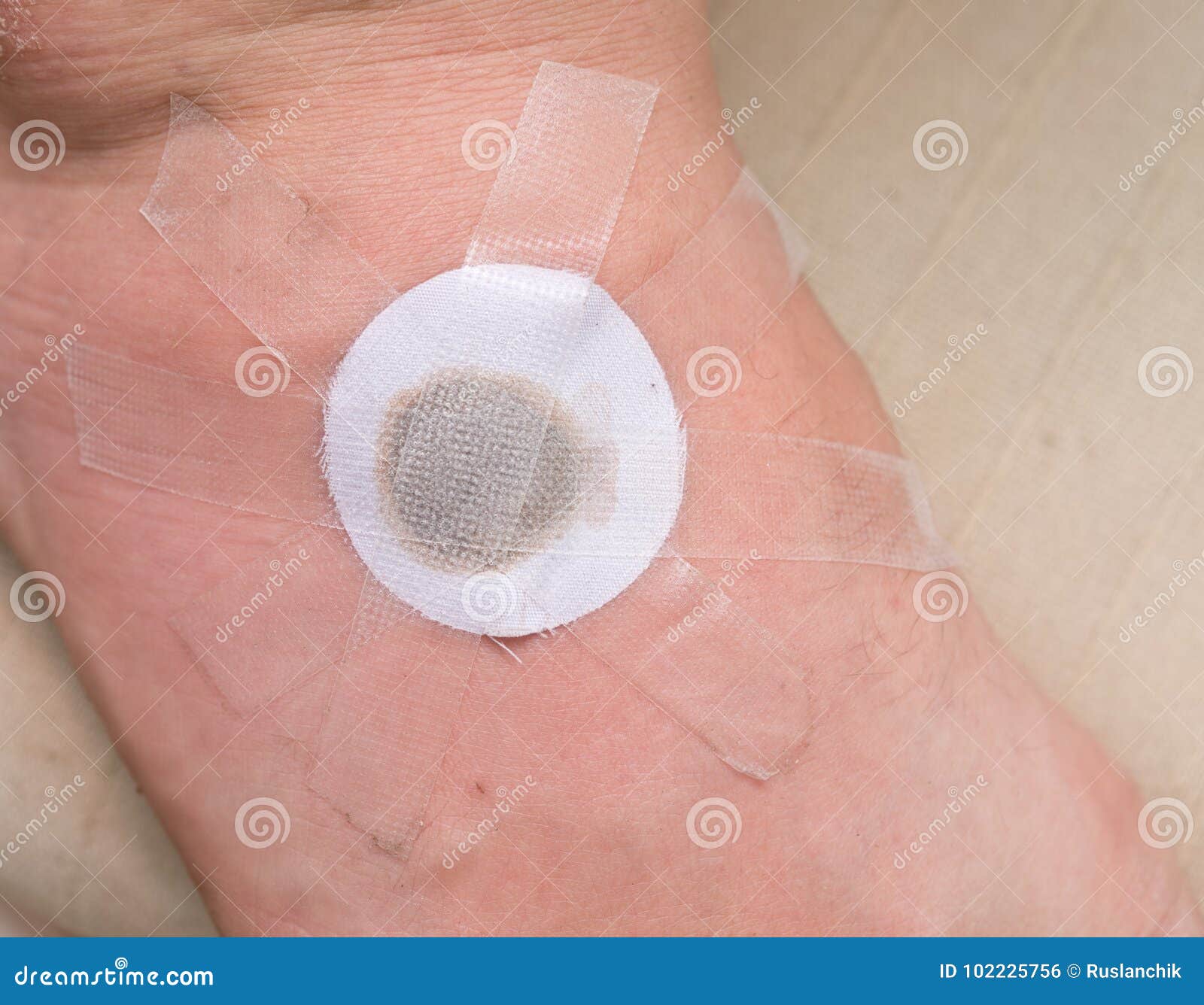 Plaster on foot stock photo. Image of sticky, wound - 102225756