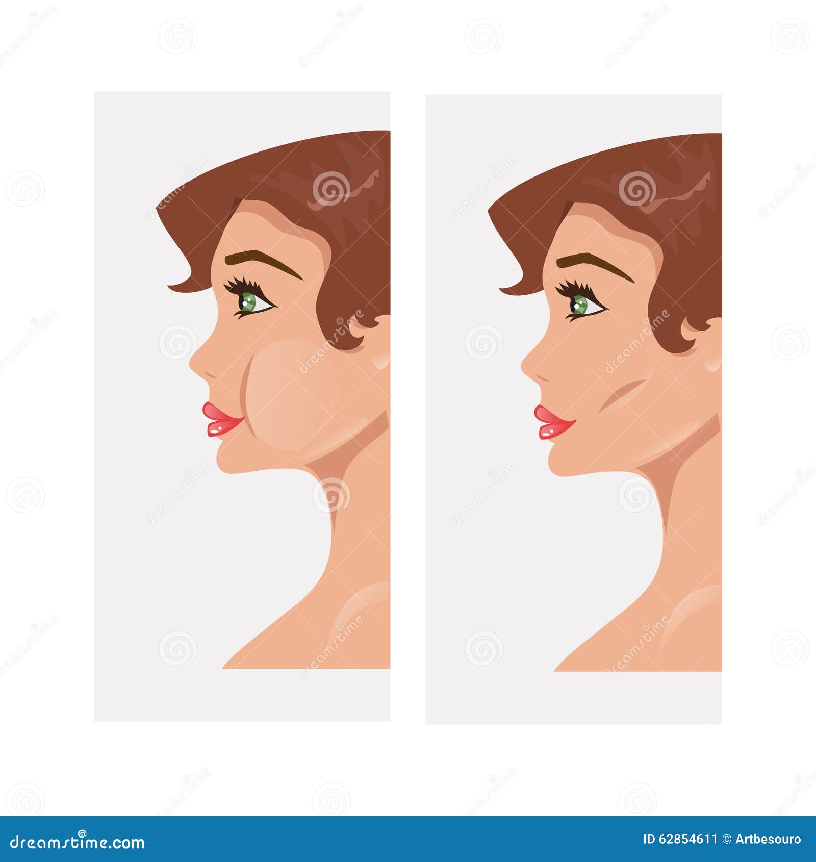 Plastic Cheekbones. Vector Illustration Stock Vector - Illustration of ...