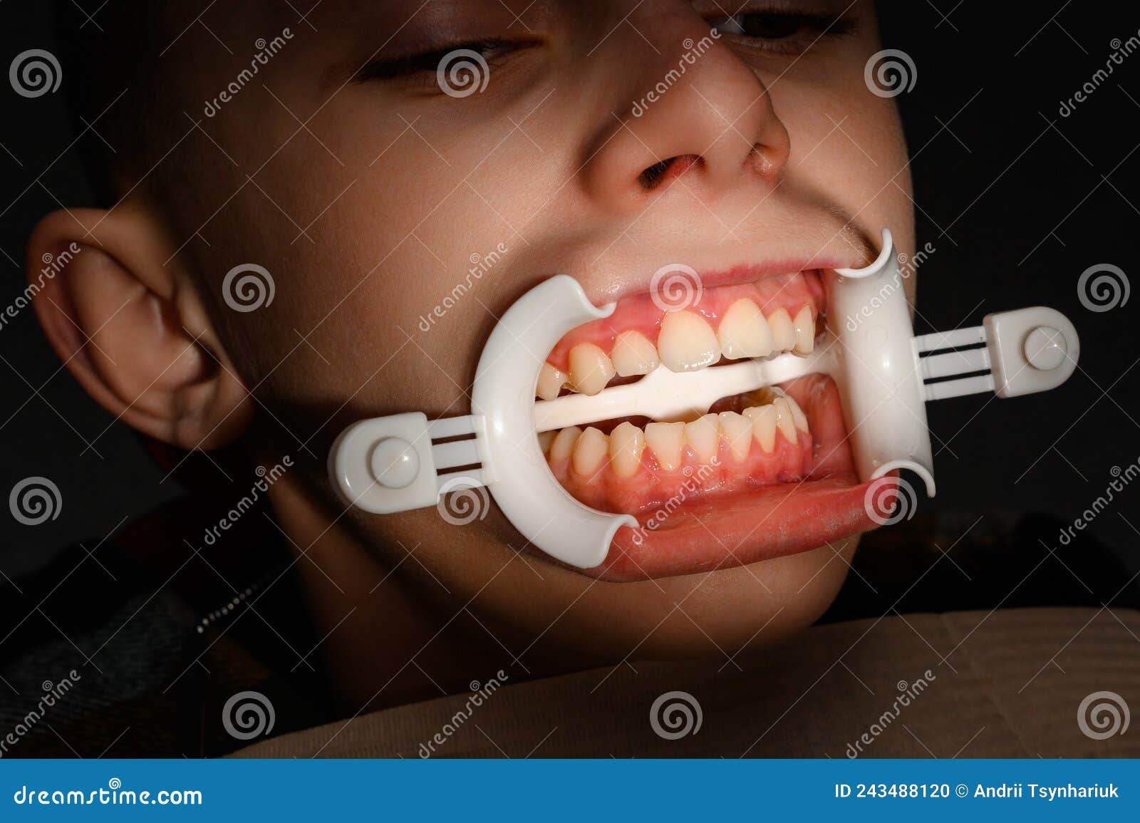 Plastic Retractor for Lip Augmentation in the Mouth, Dental Procedure ...