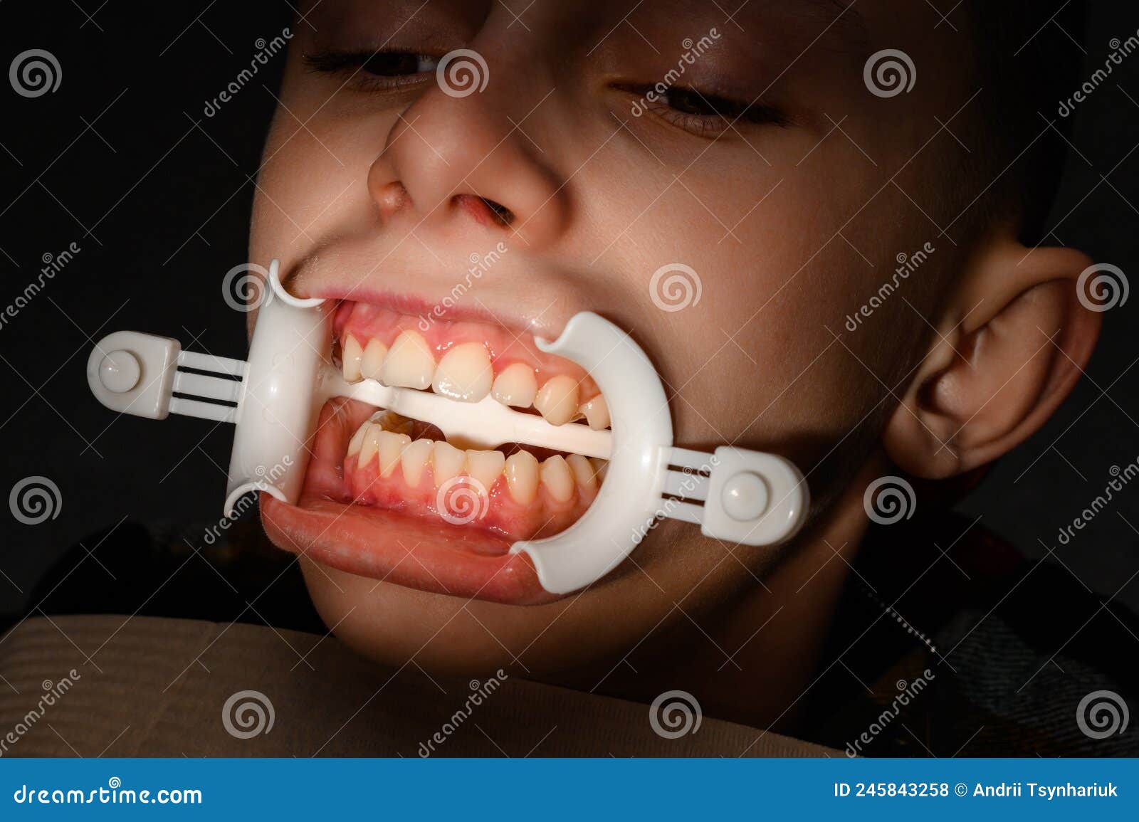 Plastic Retractor for Lip Augmentation in the Mouth, Dental Procedure ...