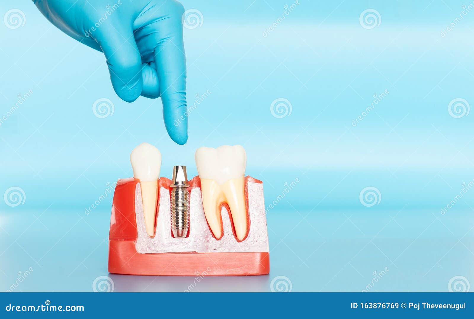 Plastic Samples of Dental Implants Compare with Natural Teeth Stock ...