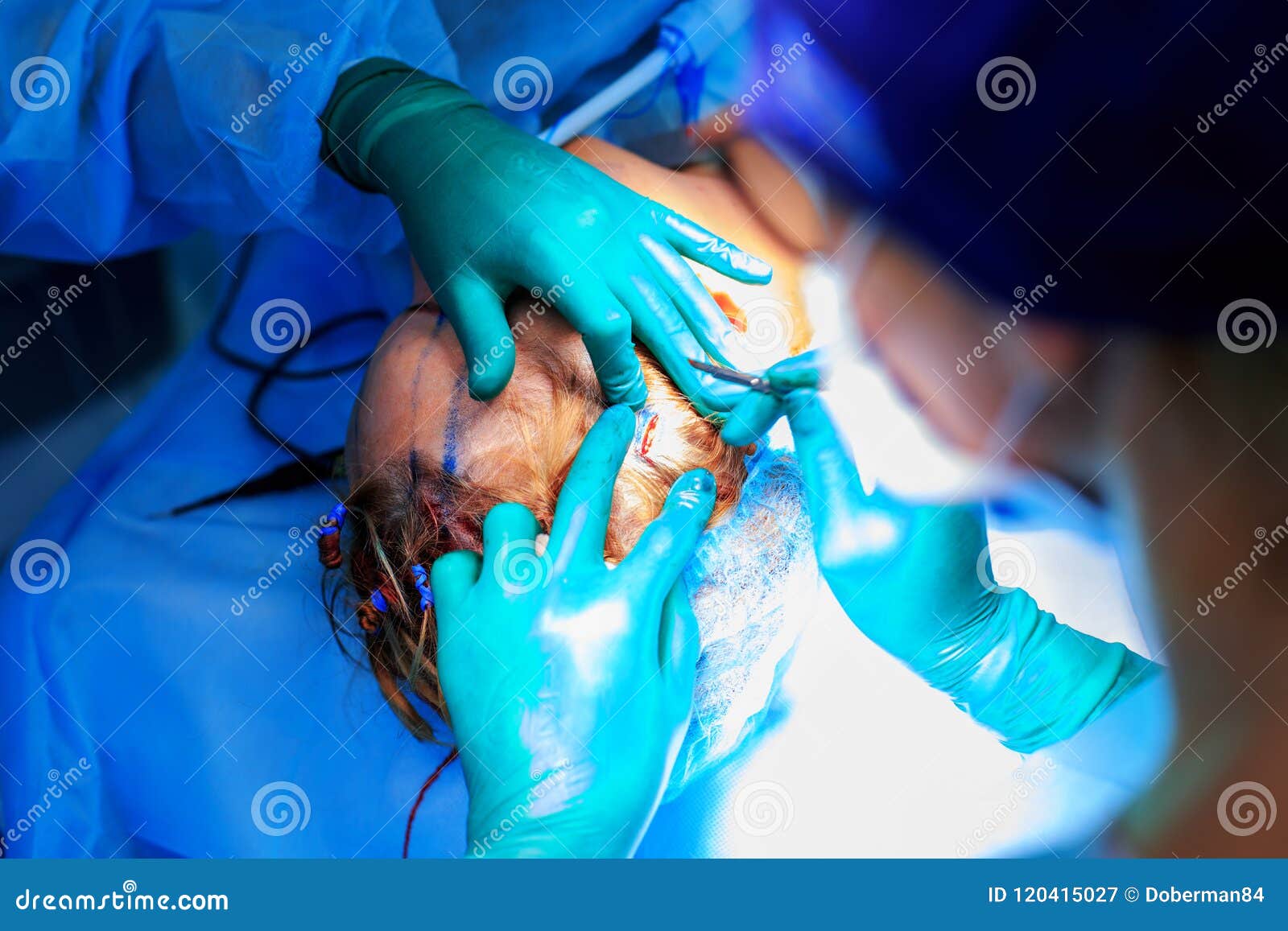 Plastic Surgery in Operational Room of Face Lifting. Stock Image ...