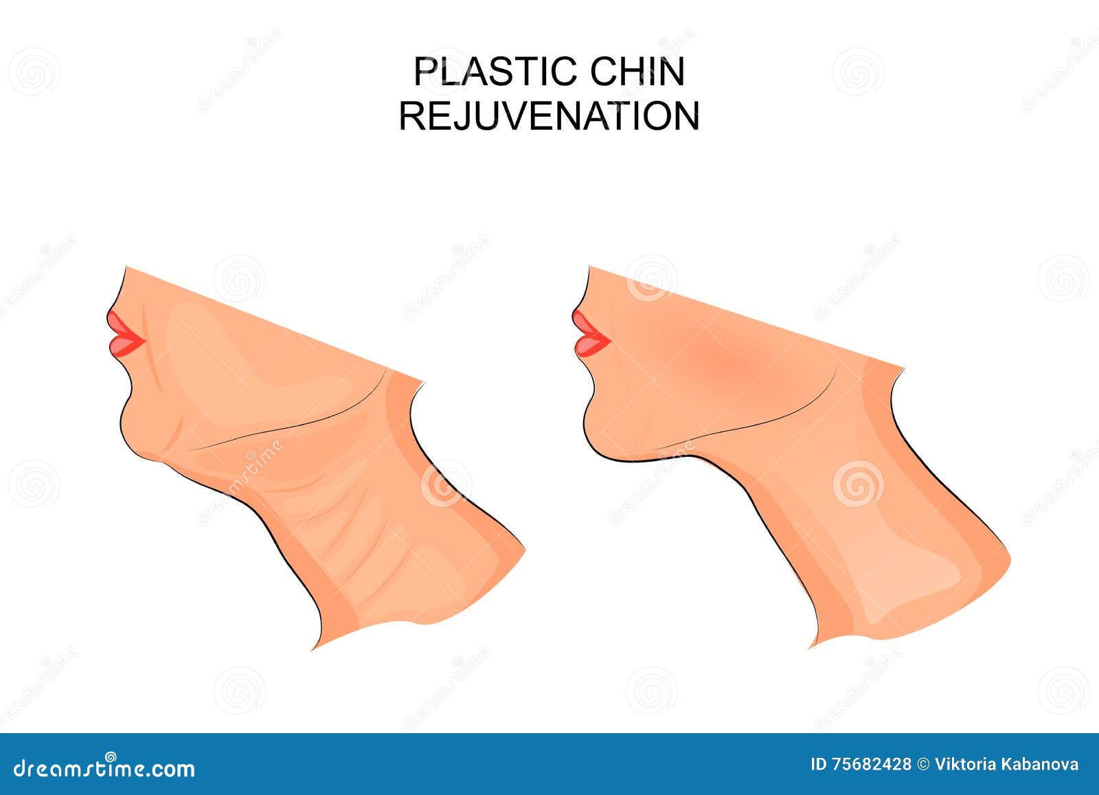 Chin Correction Procedure, Cosmetic Surgery On Female Face With Dotted ...
