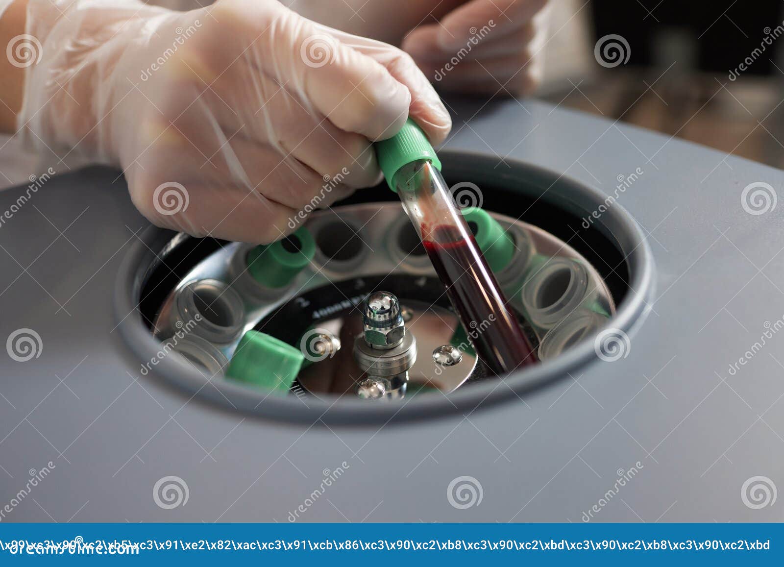 Platelet-Rich Plasma Preparation. Plasma in Syringe. Centrifuge. Stock ...