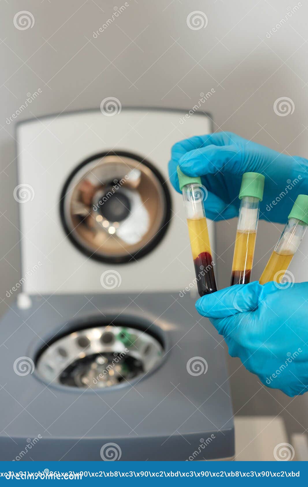 Platelet-Rich Plasma Preparation. Plasma in Syringe. Centrifuge. Stock ...