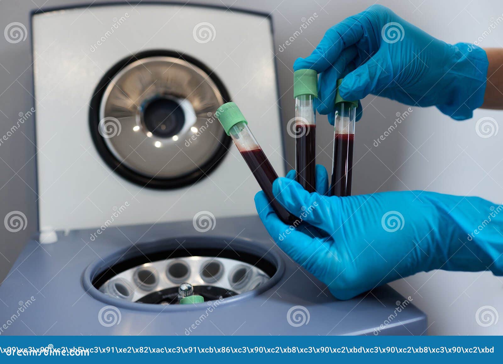Platelet-Rich Plasma Preparation. Plasma in Syringe. Centrifuge. Stock ...