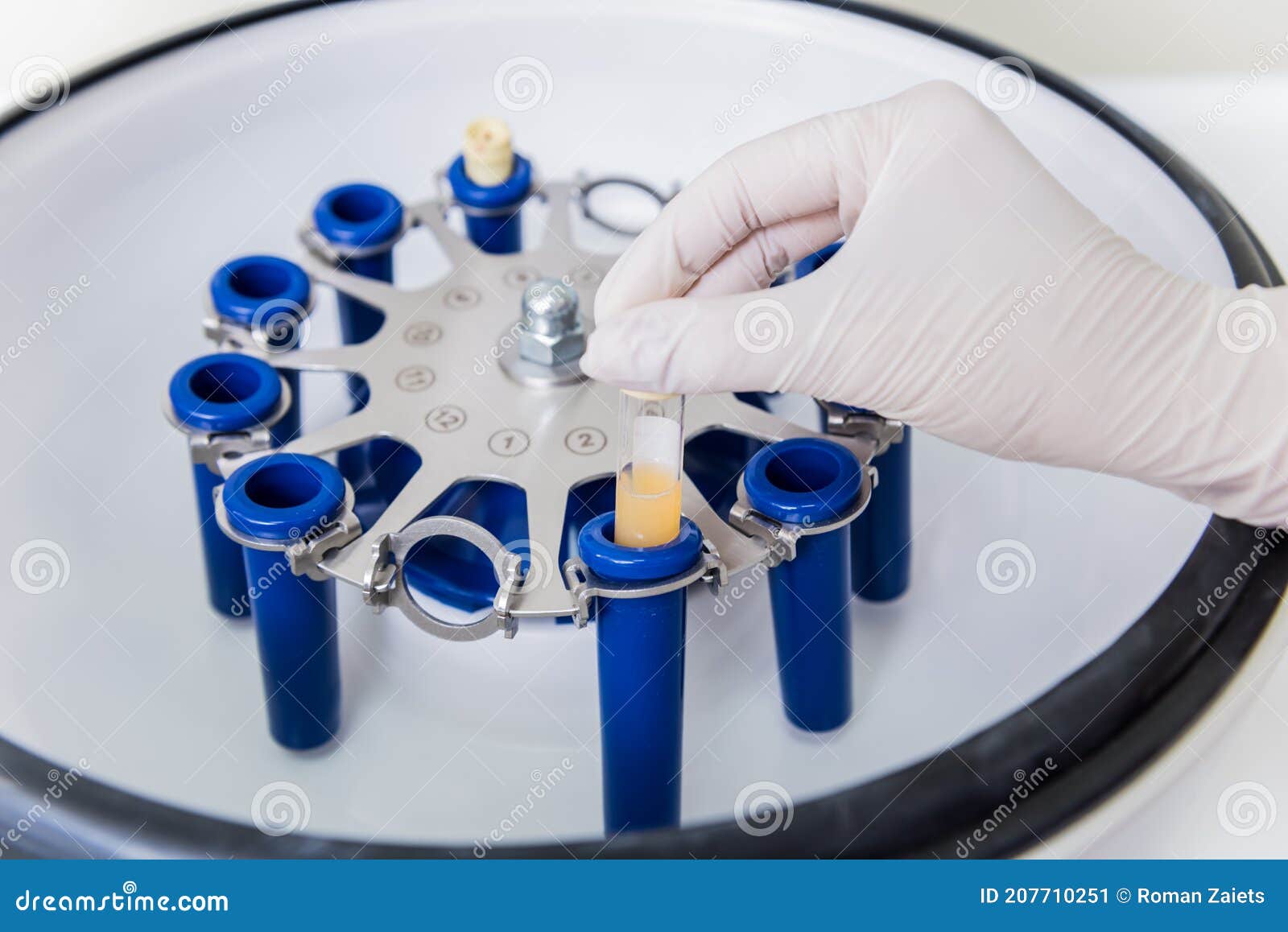 Platelet-Rich Plasma Preparation. Tube with Plasma in Hands Stock Image ...