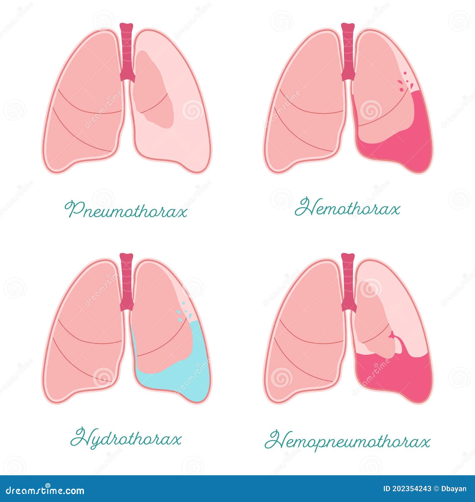 Pleural Effusions of Human Lung. Fluid or Air in Pleural Cavity ... Pleural Effusions of Human Lung. Fluid or Air in Pleural Cavity ...