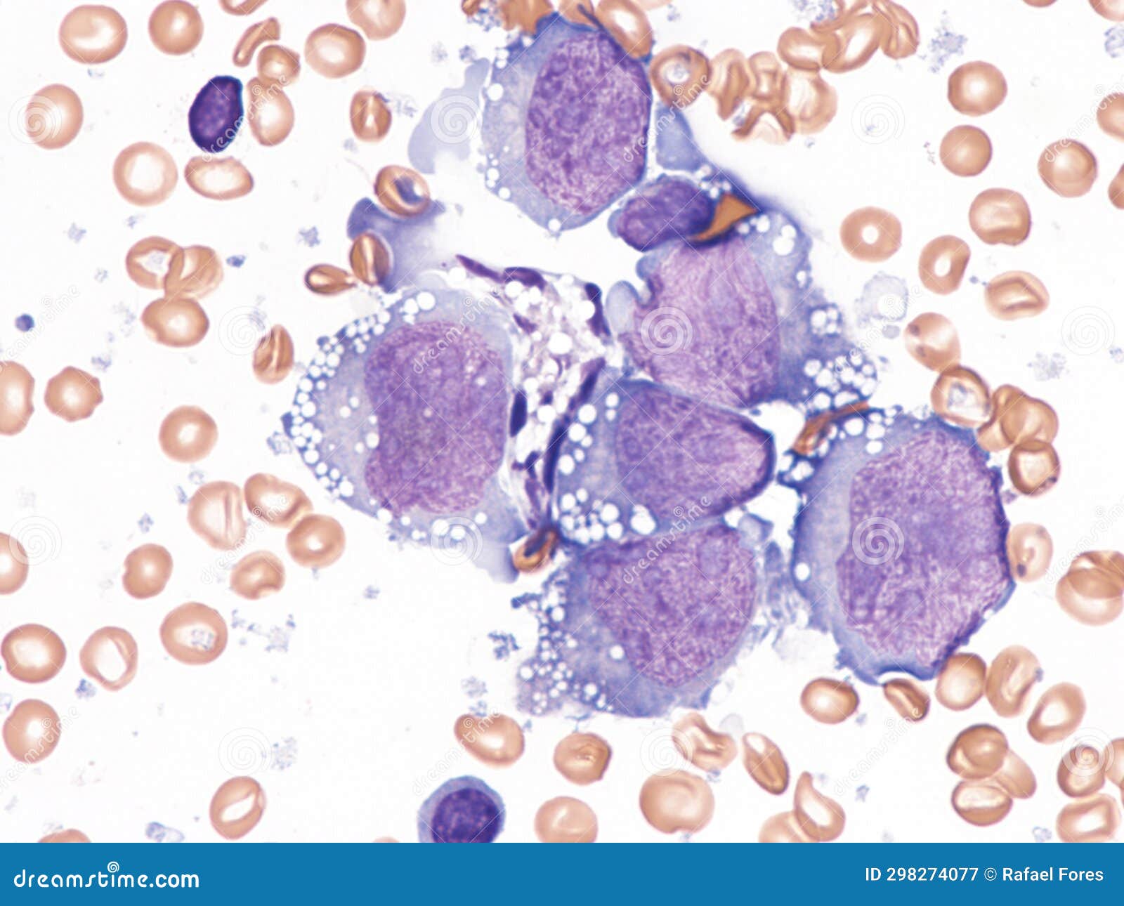 Pleural Lymphoma, Cytology. Stock Photography | CartoonDealer.com ...