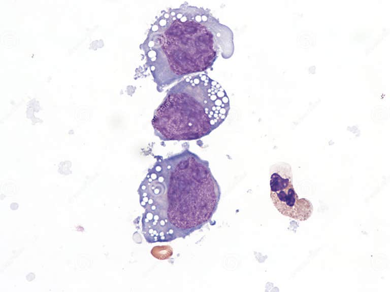 Pleural Lymphoma Cytology Stock Image Image Of Apoptotic Lymphomatous 298274115