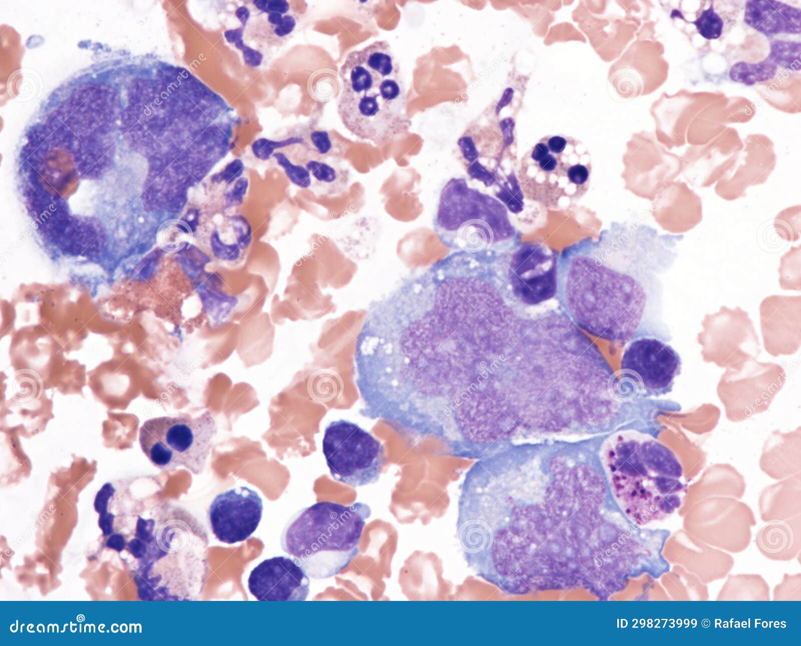 Pleural Lymphoma Cytology Stock Image Image Of Cell Medical 298273999