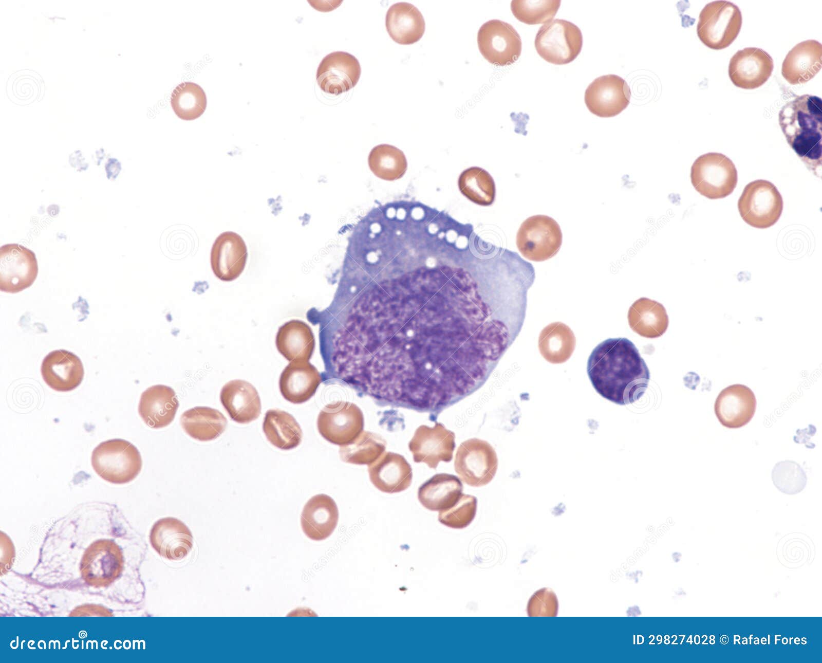 Pleural Lymphoma, Cytology. Stock Photo - Image of malignant, hodgkin ...