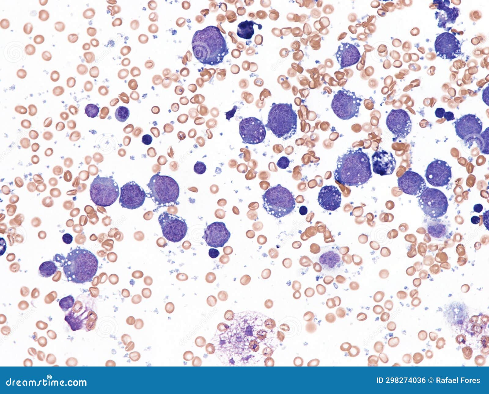 Lymphoma Cells Cytology