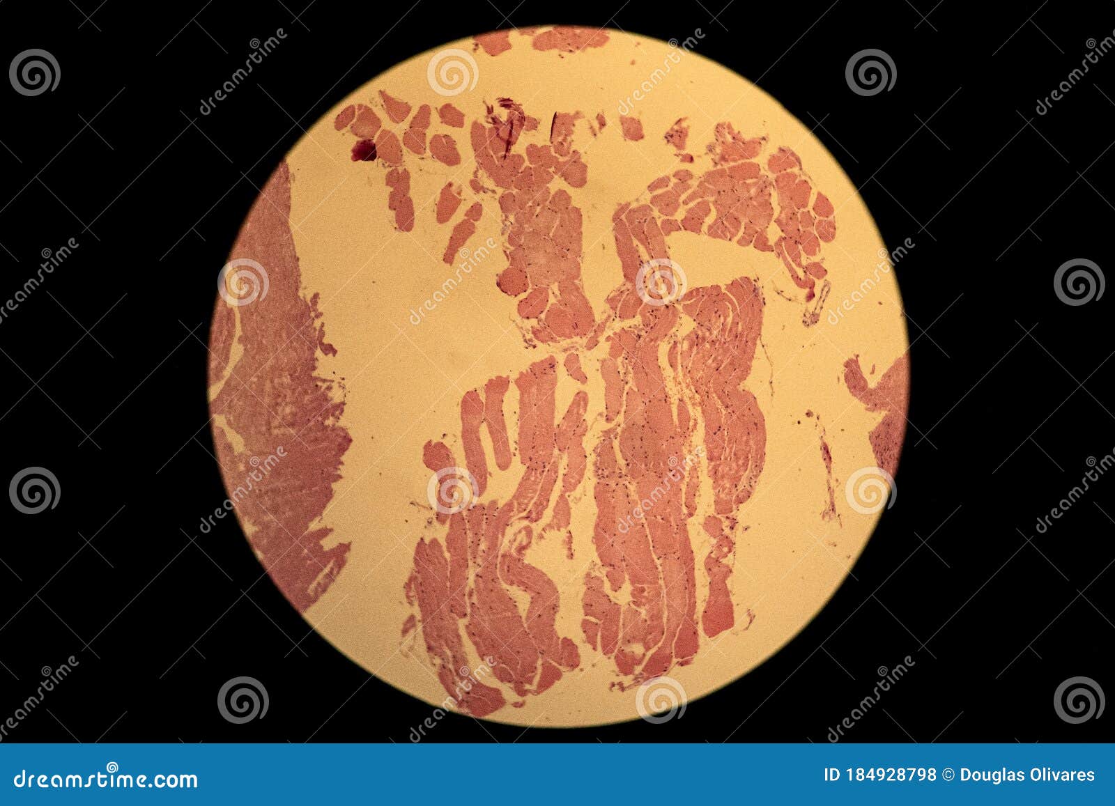 Pleural TB, Plerual Biopsy of Muscle Tissue Stock Photo - Image of ...