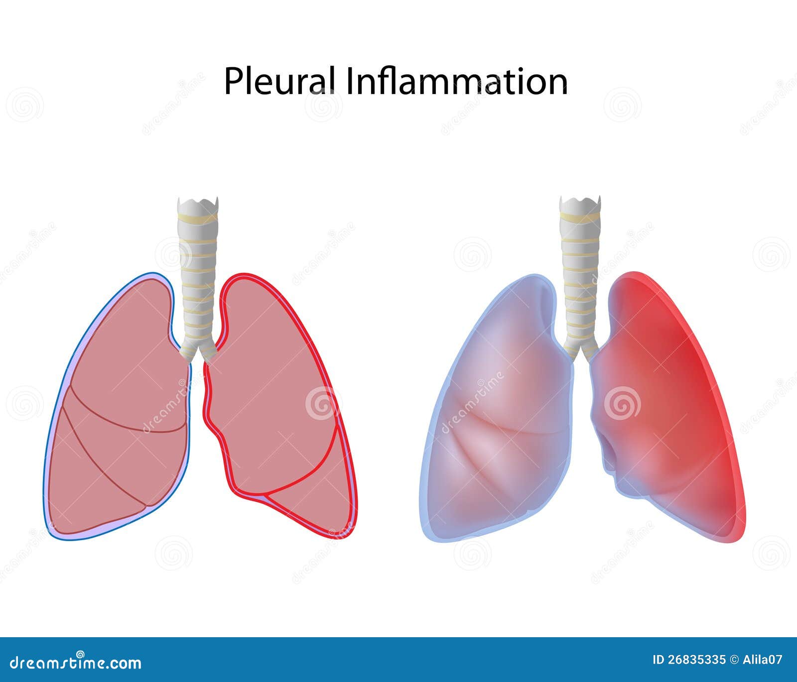 Pleuritis vector illustratie. Illustration of beeldverhaal - 26835335