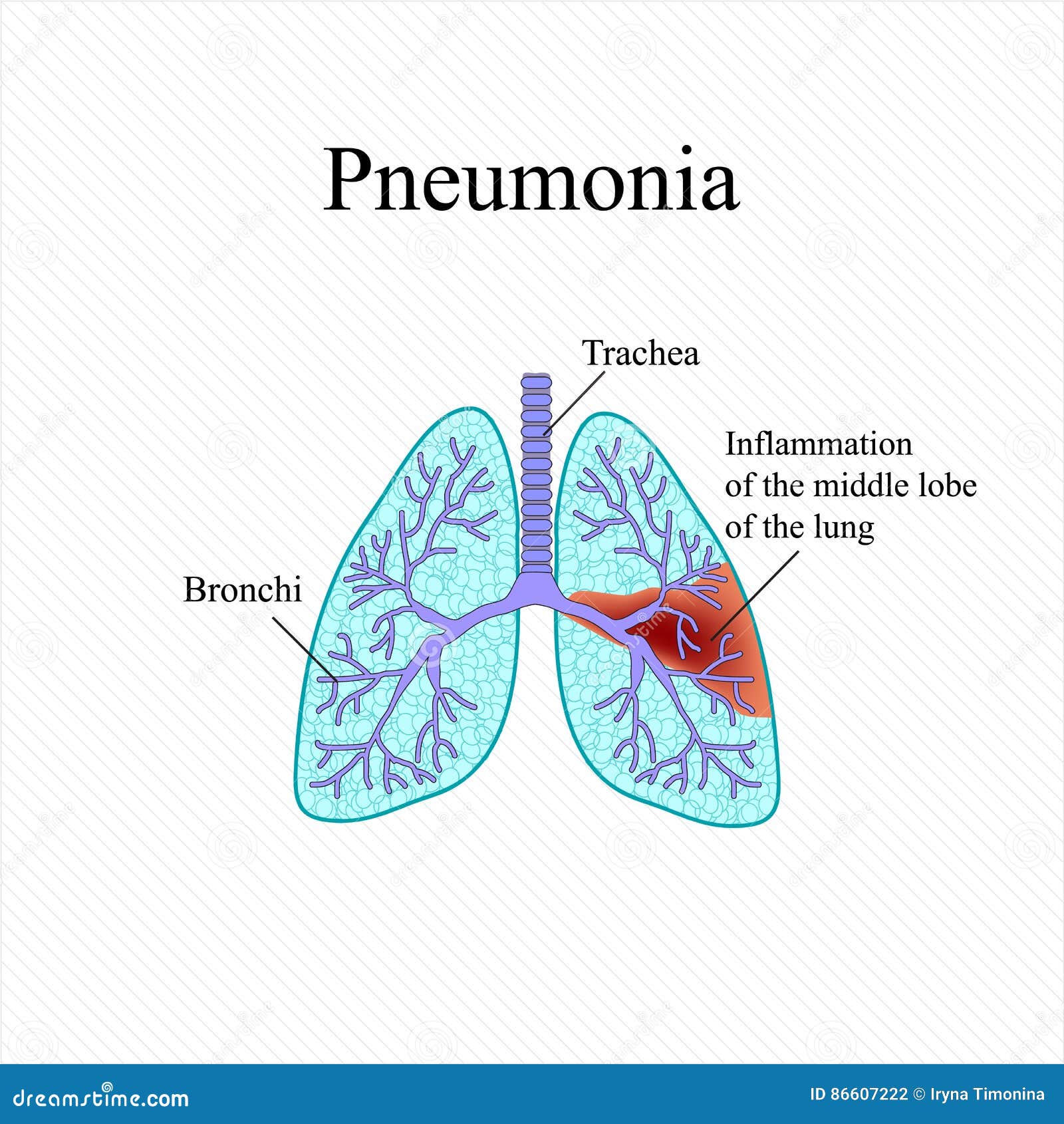 Pneumonia. The Anatomical Structure Of The Human Lung. Inflammat ...