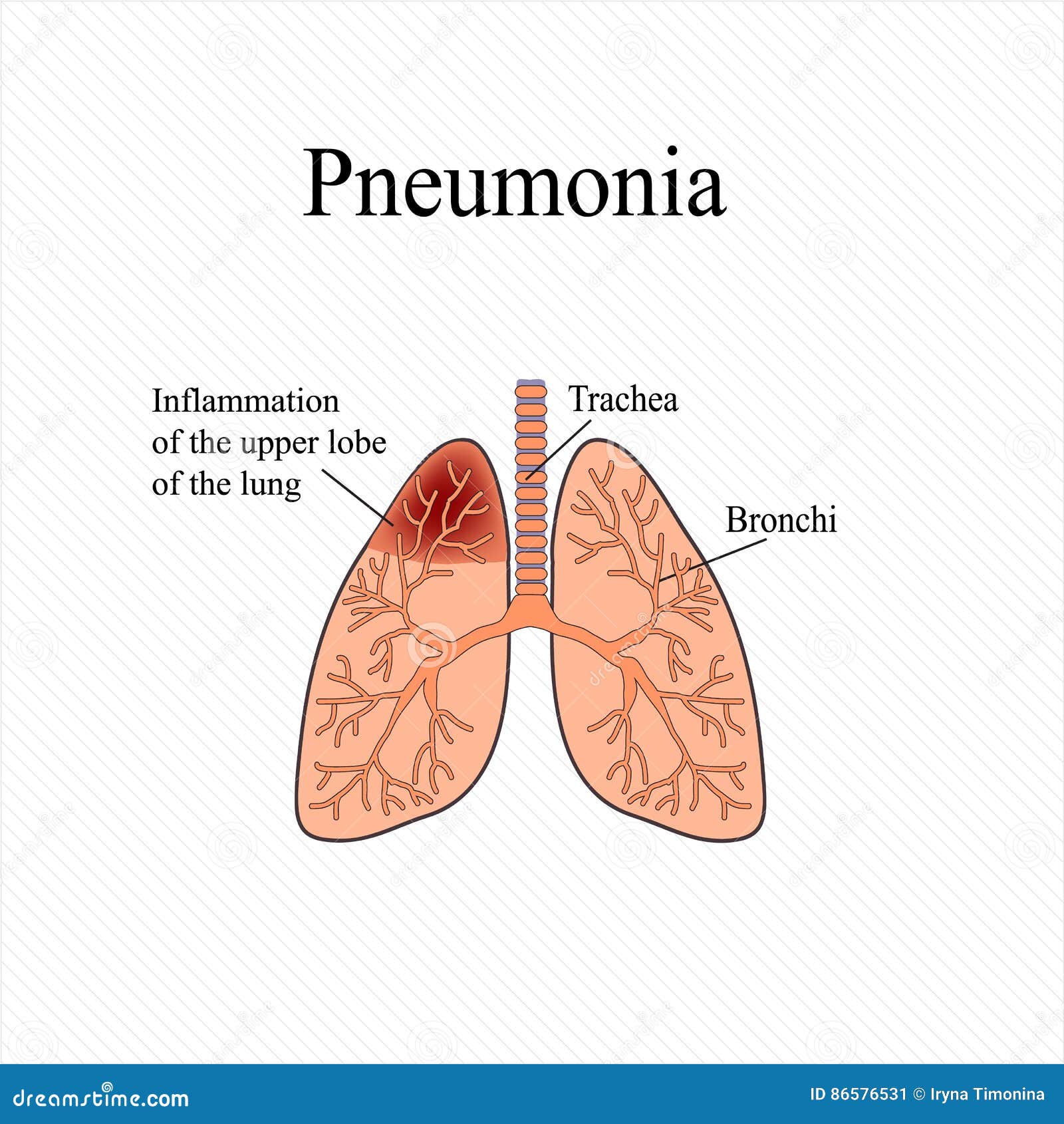 Pneumonia. The Anatomical Structure Of The Human Lung. Type Of ...