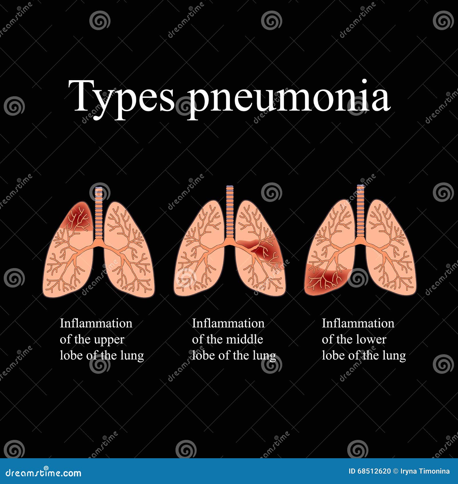 Pneumonia. the Anatomical Structure of the Human Lung. Type of ...