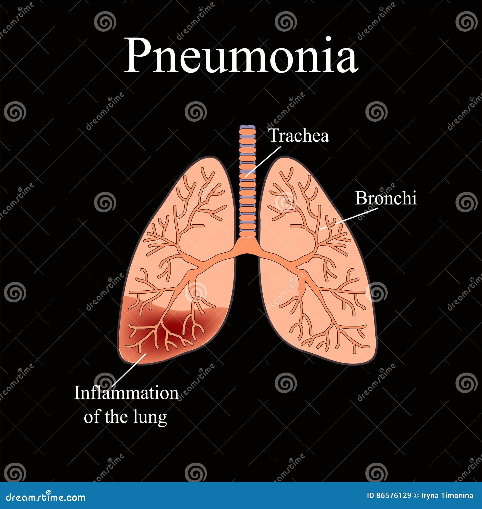 Pneumonia. the Anatomical Structure of the Human Lung Stock Vector ...