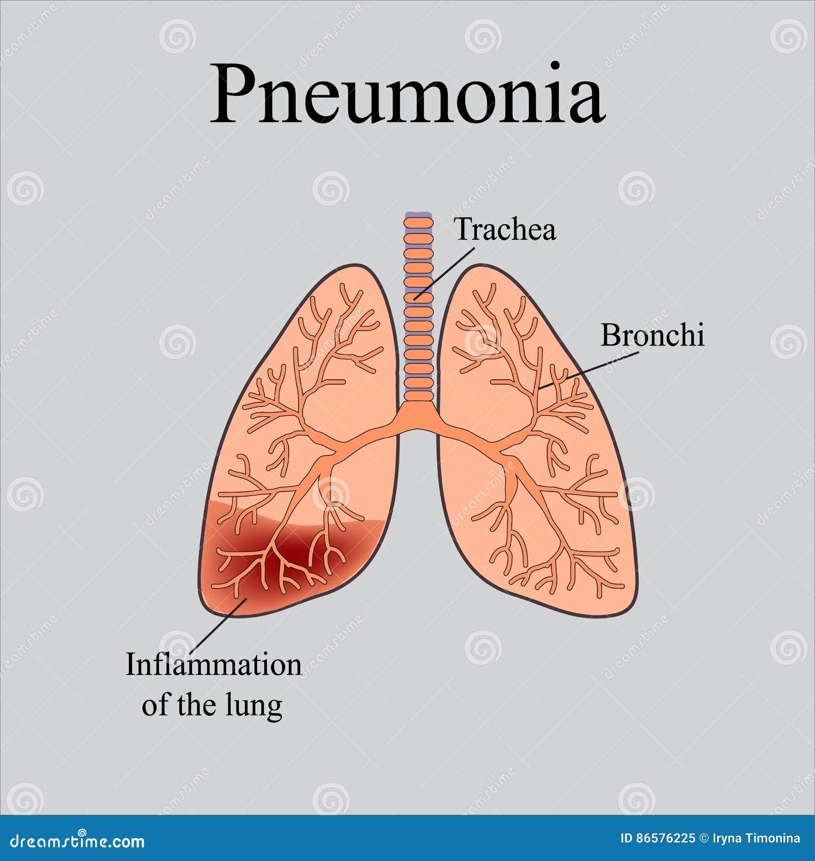 Pneumonia. The Anatomical Structure Of The Human Lung. Inflammation Of ...