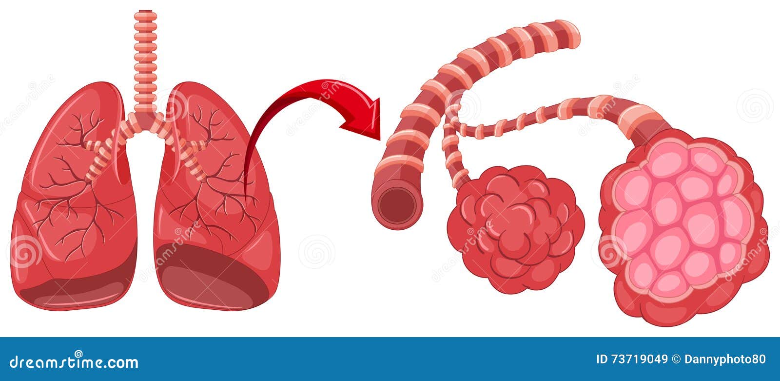 Pneumonia Diagram with Zoom in Lungs Stock Vector - Illustration of ...