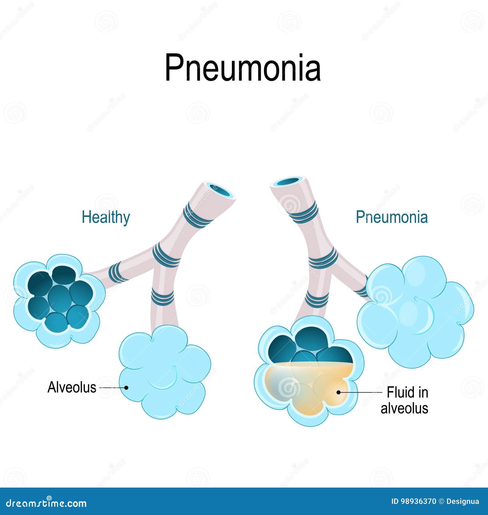 Pneumonia. Illustration Shows Normal and Infected Alveoli Stock Vector ... Pneumonia. Illustration Shows Normal and Infected Alveoli Stock Vector ...