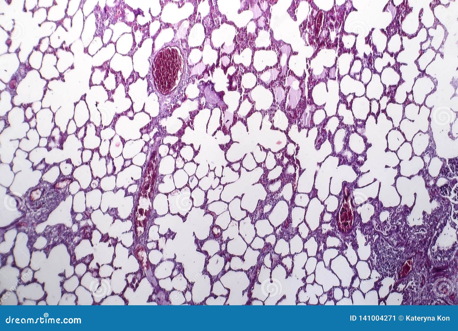 Pneumonia, Light Micrograph Stock Image - Image of micrograph, microbe ...