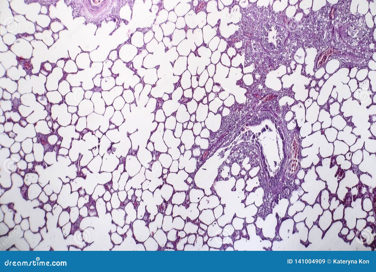 Pneumonia, Light Micrograph Stock Image - Image of microphotograph ...