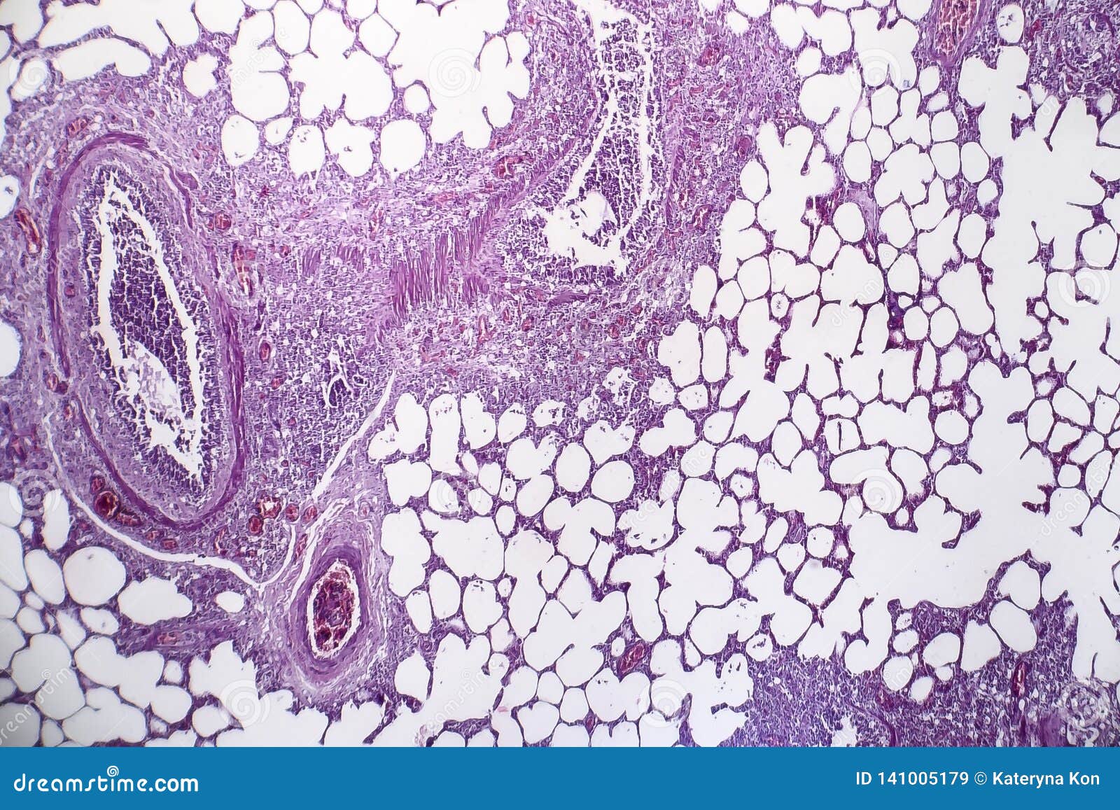 Pneumonia, Light Micrograph Stock Image - Image of cell, lung: 141005179