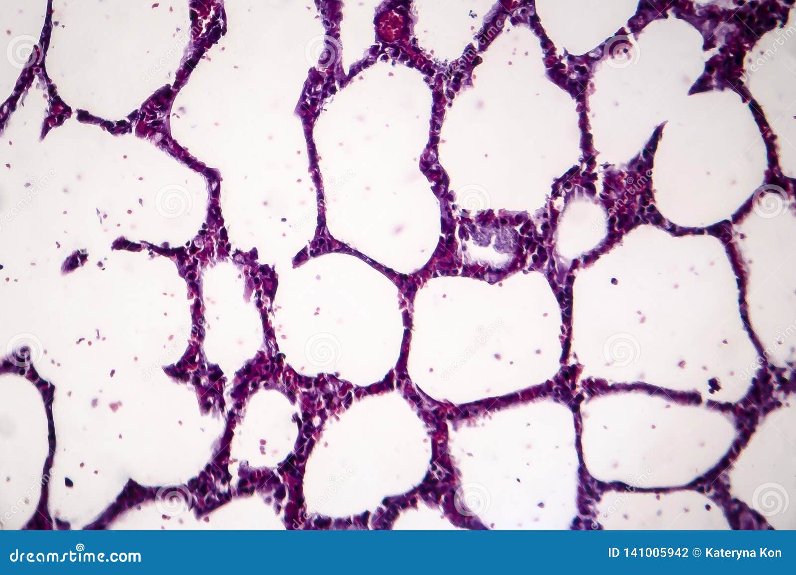 Pneumonia, Light Micrograph Stock Photo - Image of microbe, microscope ...