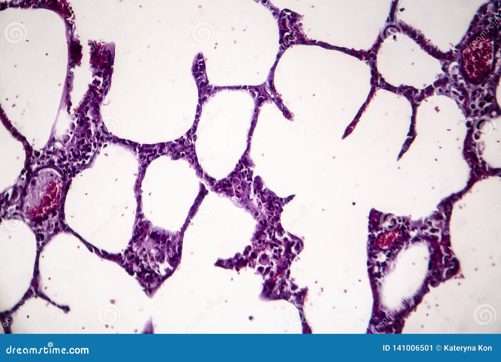 Pneumonia, Light Micrograph Stock Image - Image of medicine, histology ...