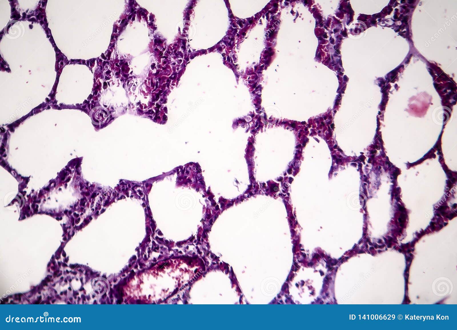 Pneumonia, Light Micrograph Stock Image - Image of bacterial ...