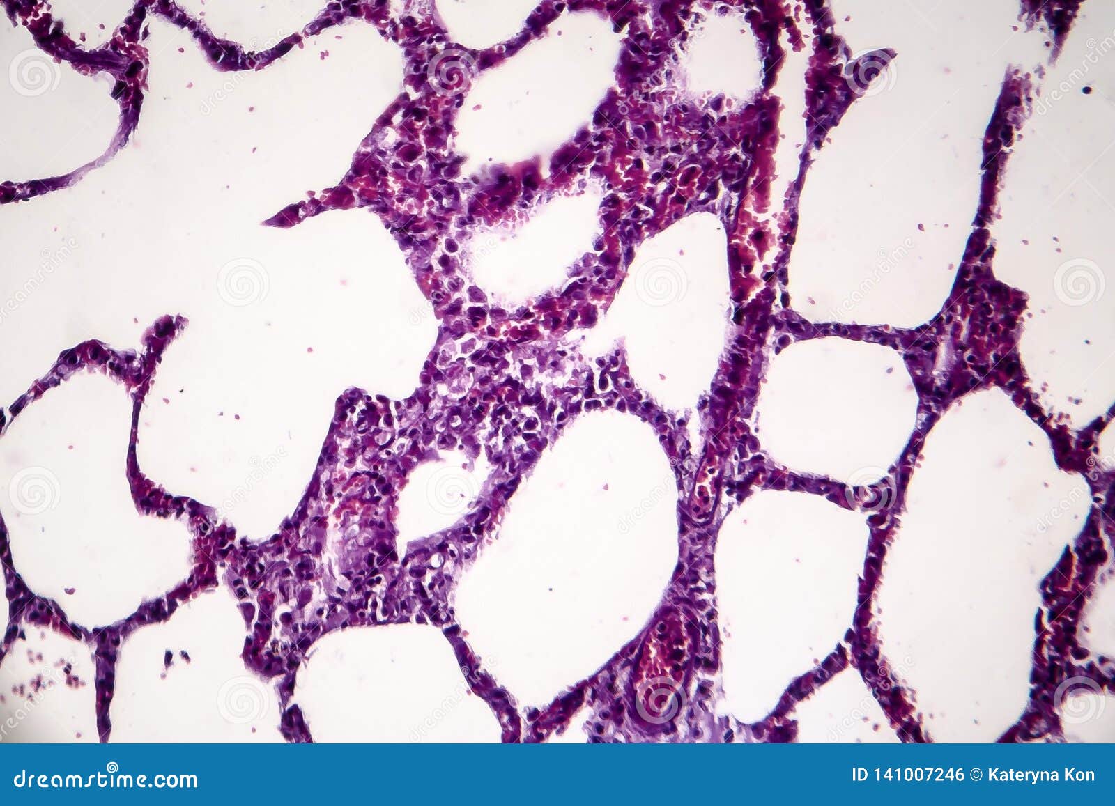 Pneumonia, Light Micrograph Stock Photo - Image of morphological ...