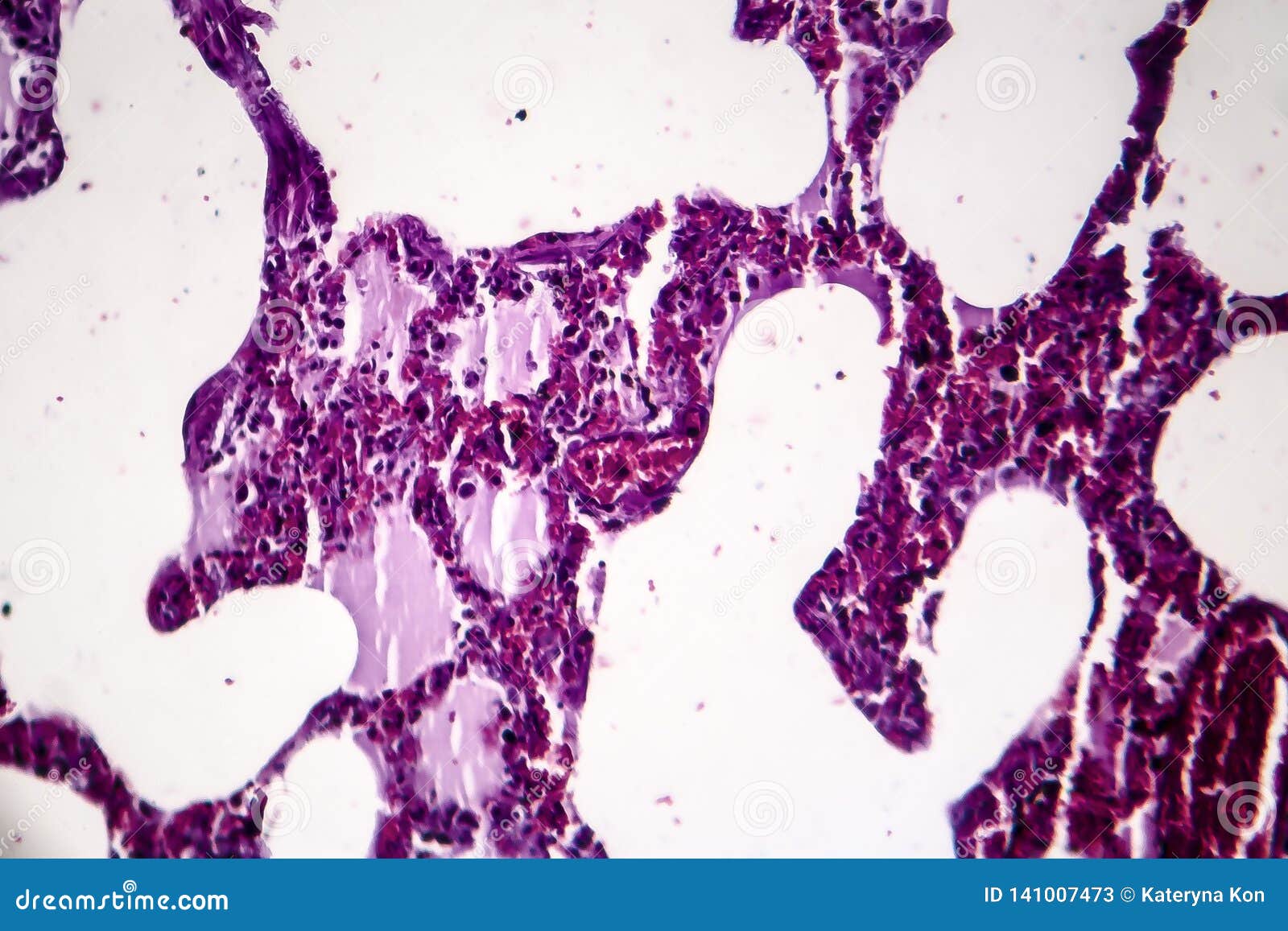 Pneumonia, Light Micrograph Stock Image - Image of alveolar, aspiration ...