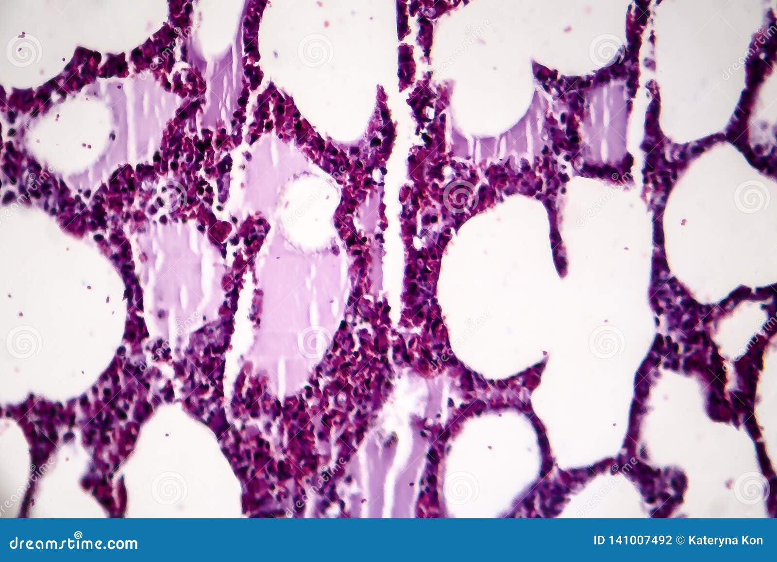 Pneumonia, Light Micrograph Stock Photo - Image of morphological ...