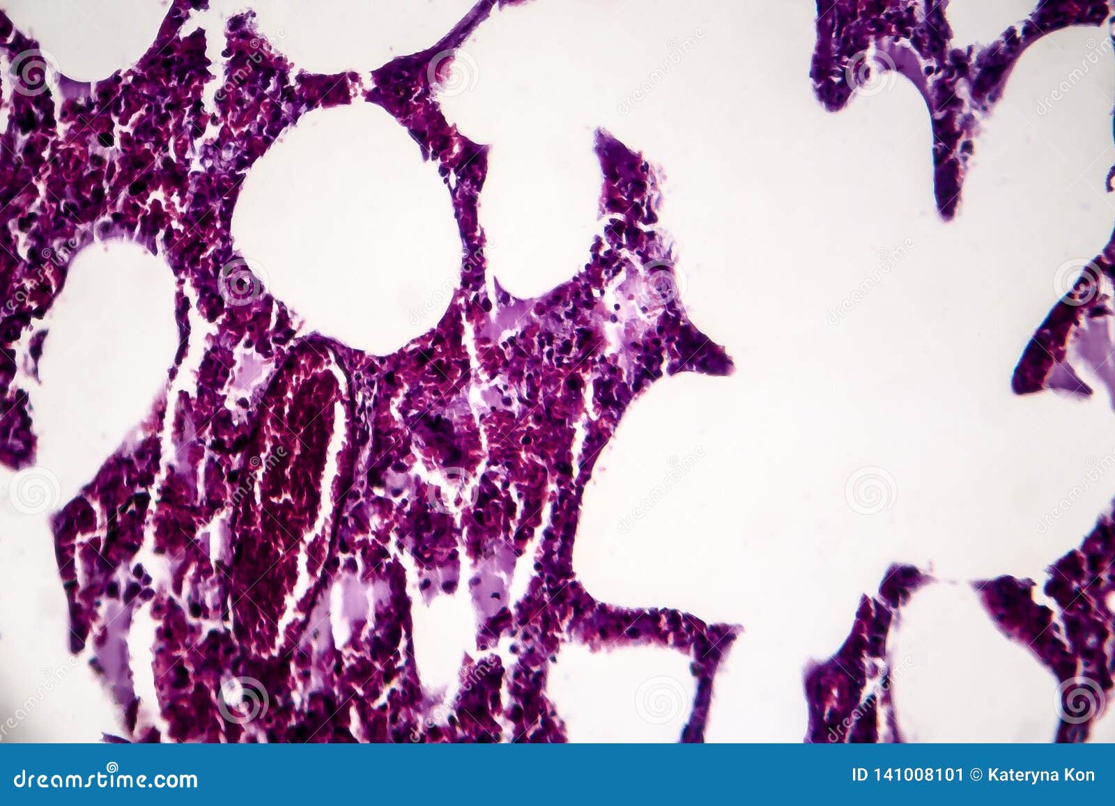 Pneumonia, Light Micrograph Stock Image - Image of micro, alveolar ...