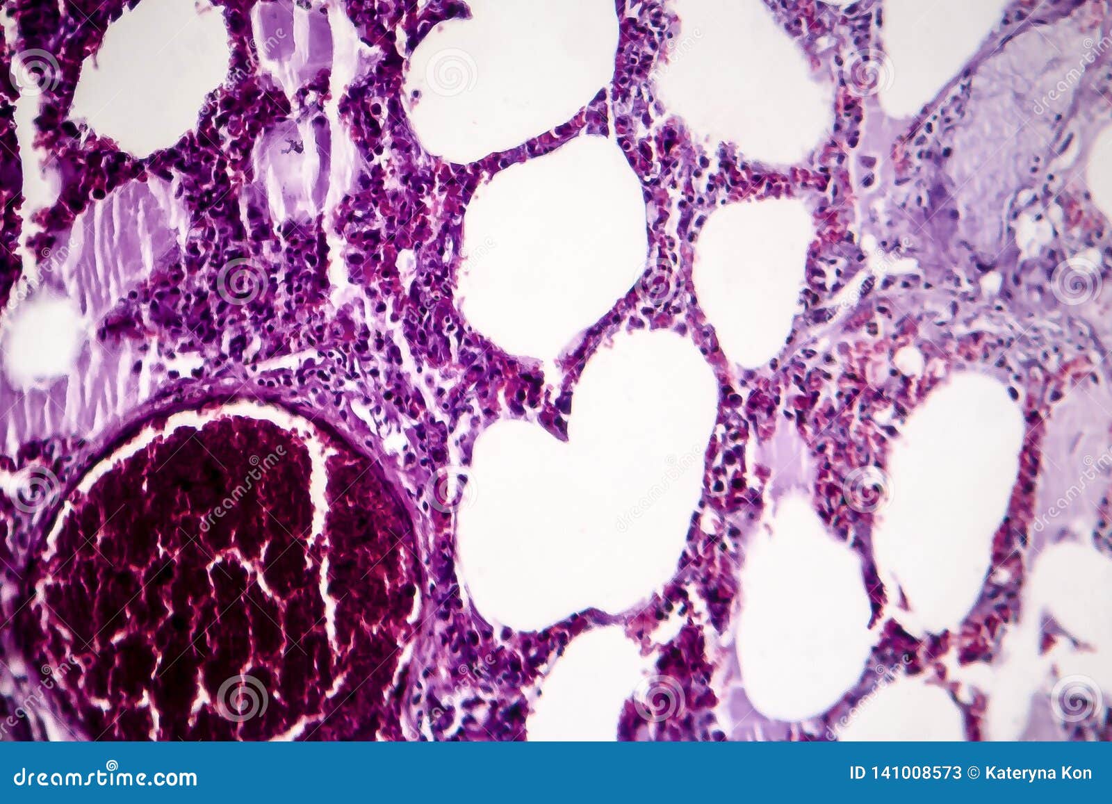 Pneumonia, Light Micrograph Stock Image - Image of medicine, microbe ...