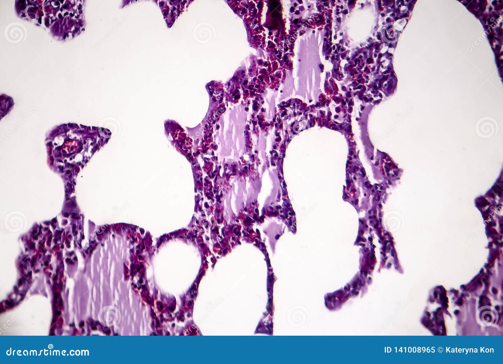 Pneumonia, Light Micrograph Stock Image - Image of histology ...