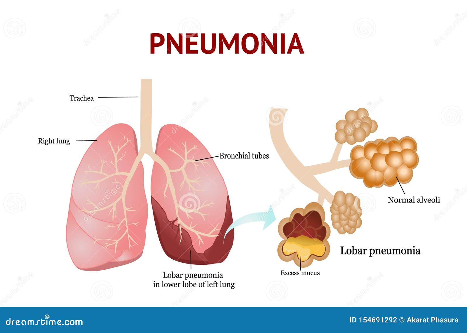 Pneumonia, Lobar Pneumonia, Isolated Vector Illustration on White ...