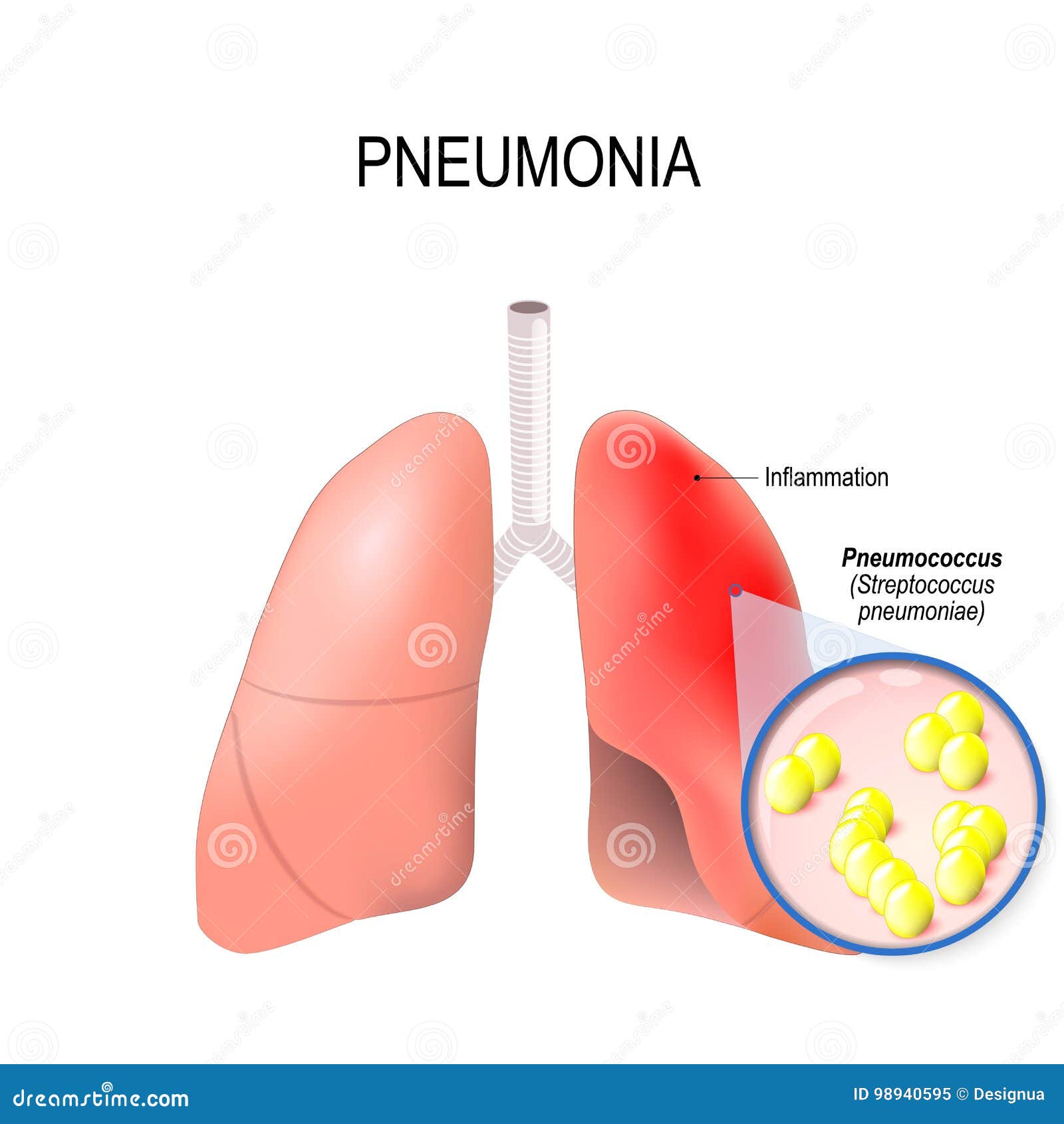 Pneumonia. Normal And Infected Alveoli. Healthy And Ilness Lungs ...