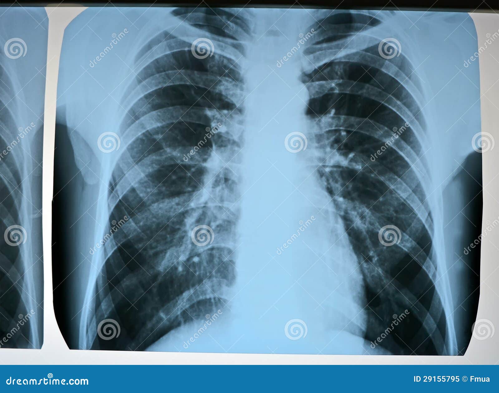 Pneumonia Test Scanning, Modern X-rays Radiography. Stock Image - Image ...