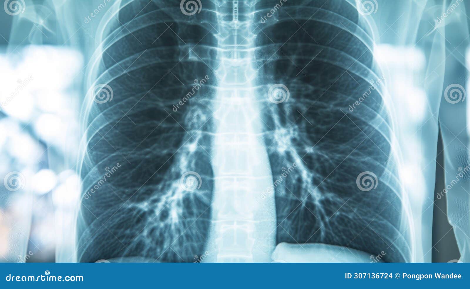 Pneumonic Lung and Pleural Fluid in X-ray Image Stock Illustration ...