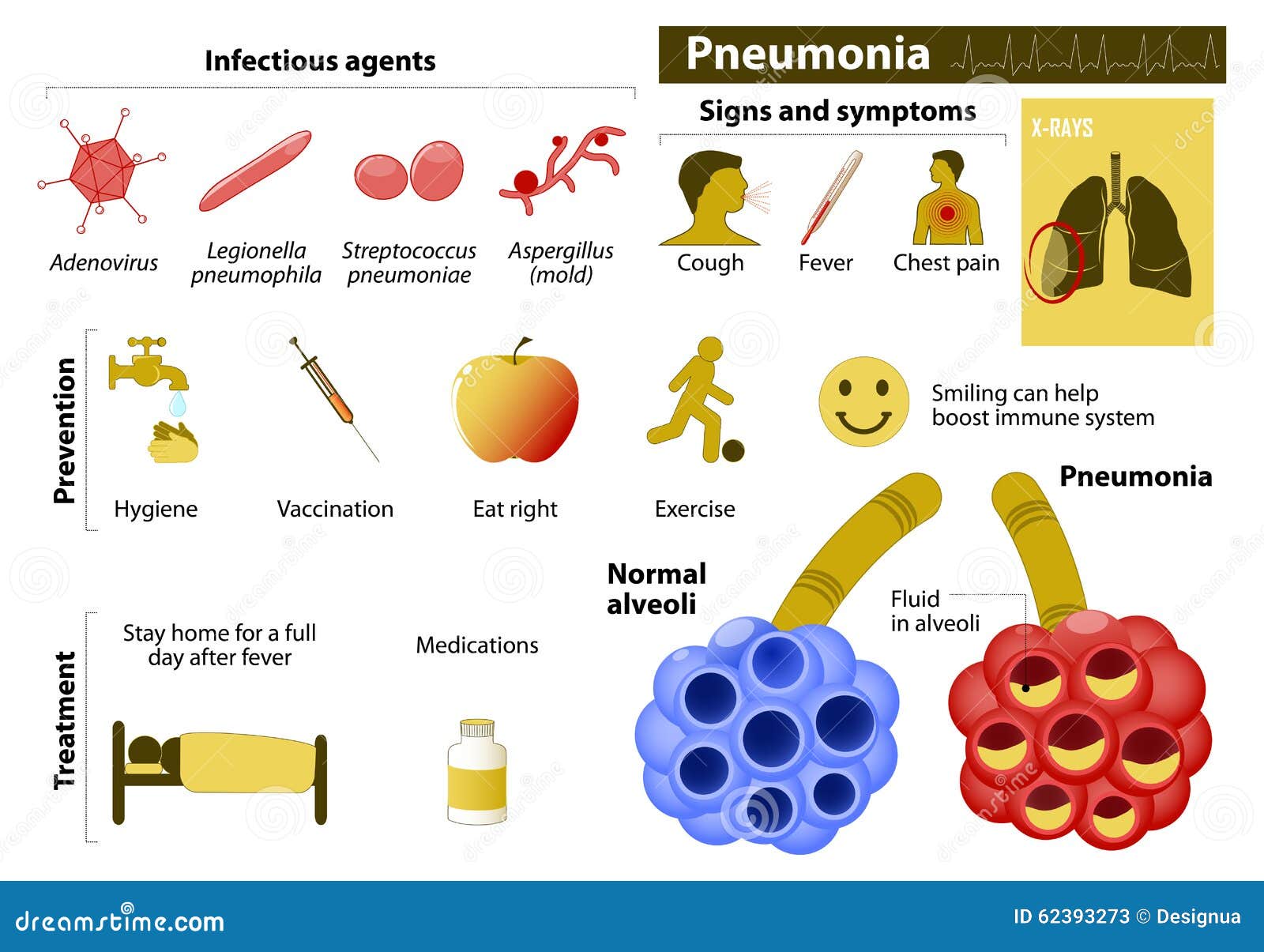 Pneumonie vektor abbildung. Bild von menschlich, karosserie - 62393273