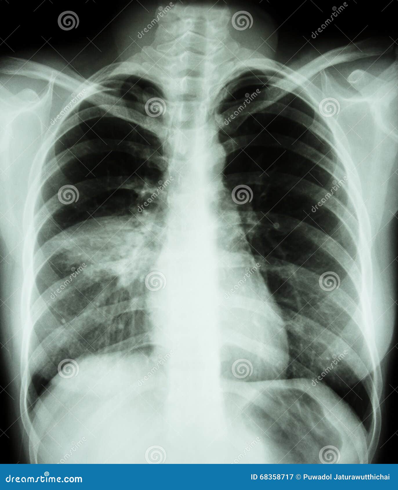 Pneumonie image stock. Image du soin, diagnostic, blessures - 68358717