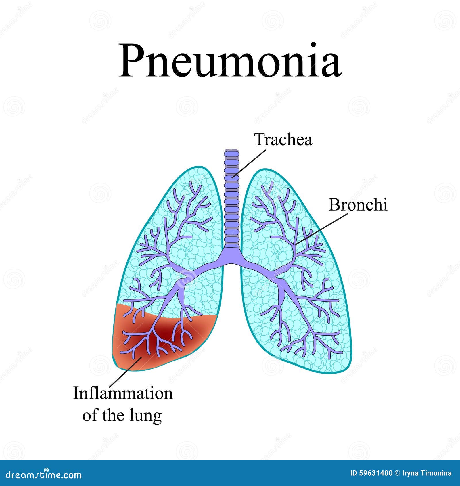 Pneumonie Die Anatomische Struktur Des Menschen Vektor Abbildung - Bild ...